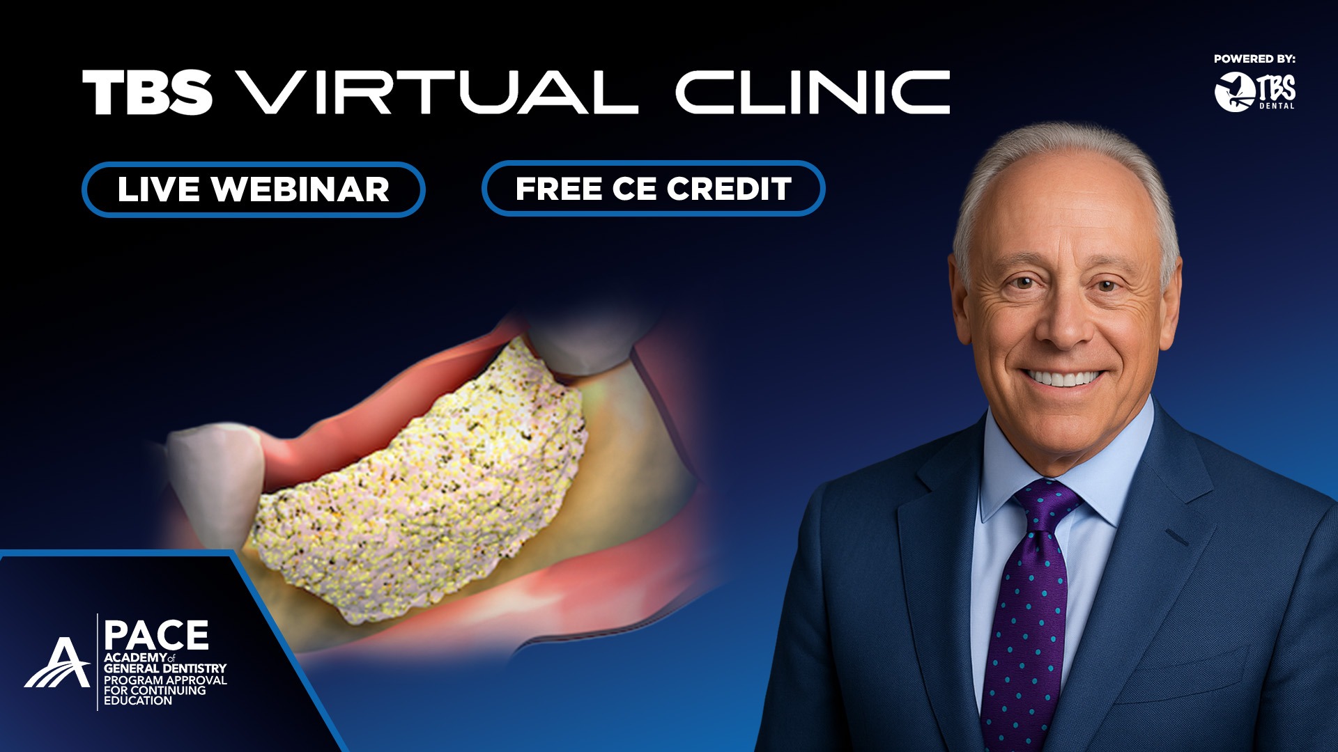 Avoiding Future Bone Loss: Preemptive Bone Sculpting | TBS Dental